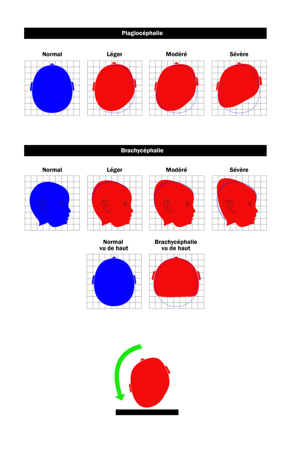 Pediatrics: Preventing plagiocephaly and torticollis in children